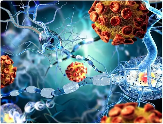 Autoimmune encephalitis 7997_1