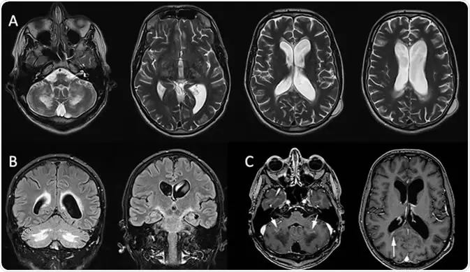 Mi az adrenoleukodystrophia?