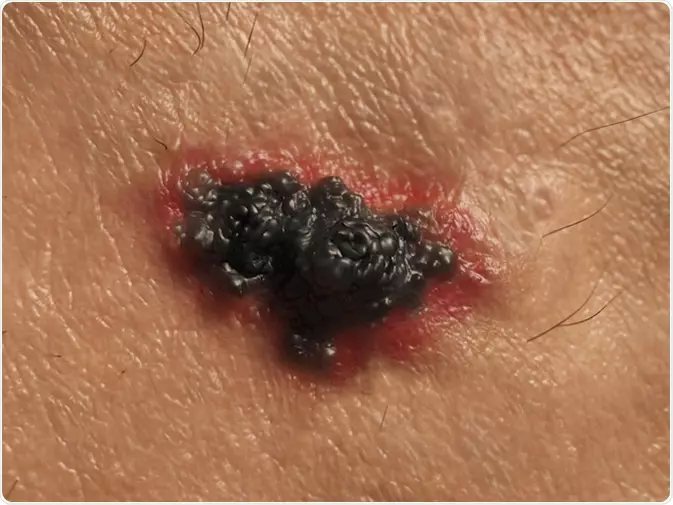 Malignant nga melanoma. Kredito sa Hulagway: Juan Gaertner / Shutterstock