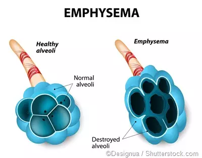 Emphysema illustration alveoli - Designua