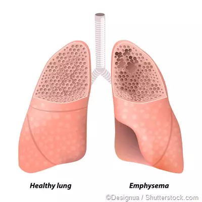 emphysema lung illustration - Designua