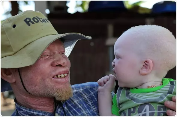 Albinism - Ib nrab tsis muaj xim nyob rau hauv daim tawv nqaij