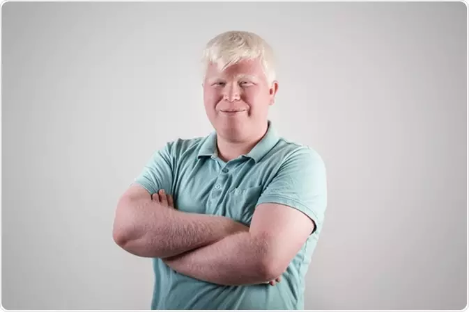 Vad är albinism?