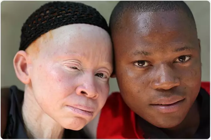 Albinism diagnos