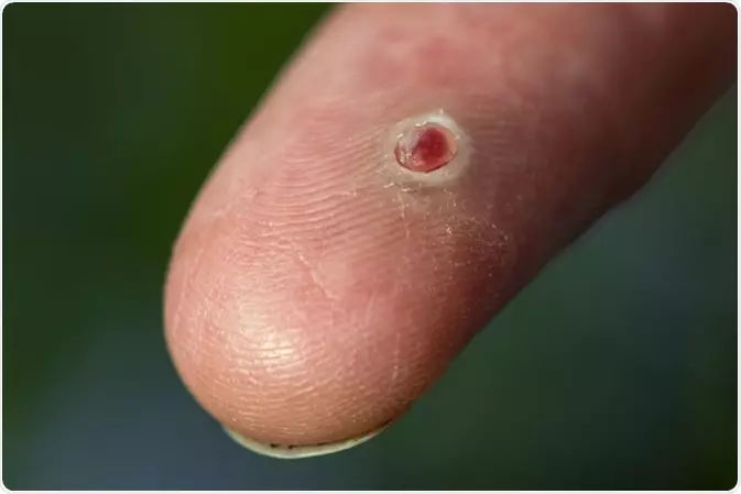 Pyogenic granuloma leqeba la mali monoaneng - Mokitlane oa Litšoantšo: CLS Digital Arts / Shutterstock