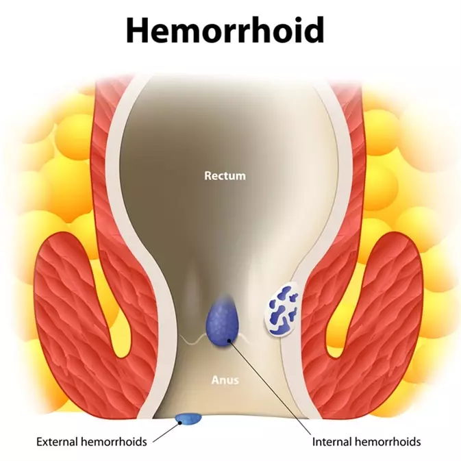 Diagramu la anusan anatomion. internaj kaj eksteraj hemoroidoj. Homa anatomio - Imnage Kredito: Designua / Shutterstock