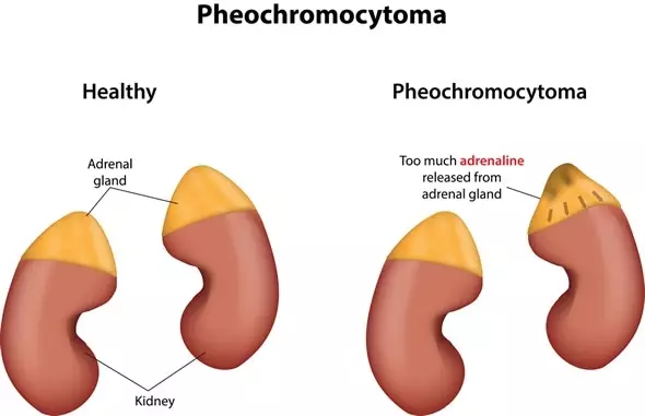 Pheochromocytoma - ikike nwebisiinka: joshya / Shutterstock