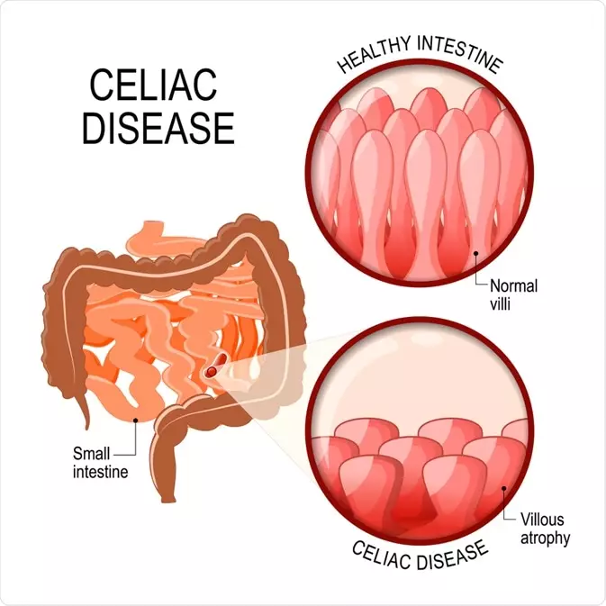 ការមិនអត់ឱន Gluten / អាឡែស៊ី 933_1