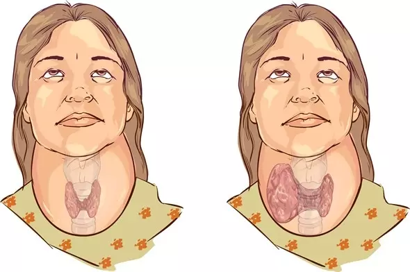 Goiter - د انځور حقوق: corbac40 / Shutterstock