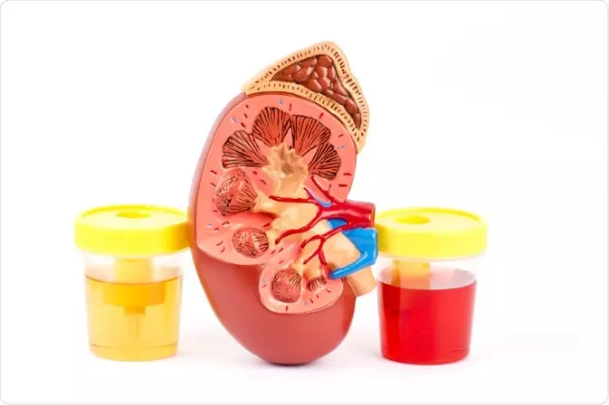 Mga Uri ng Hematuria 9784_1